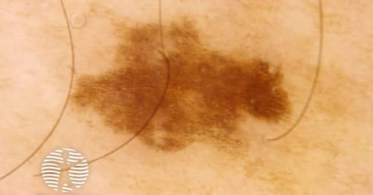 Dermatoscopy of seborrhoeic keratosis image