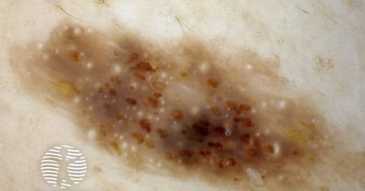 Dermatoscopy of seborrhoeic keratosis image
