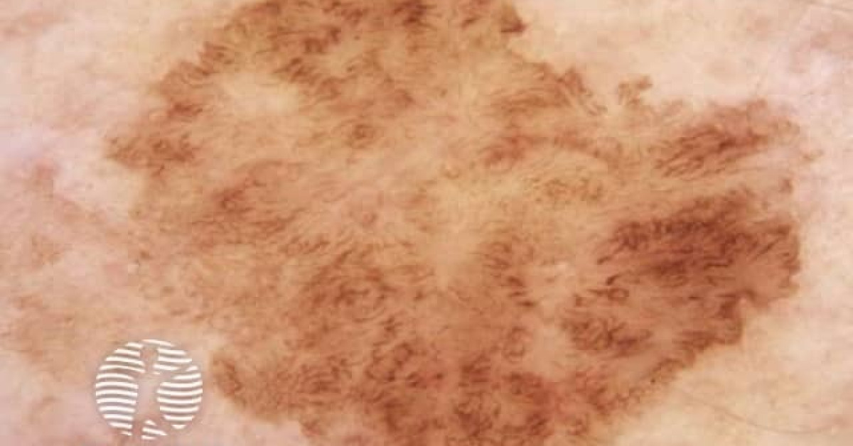 Dermatoscopy of solar lentigo image