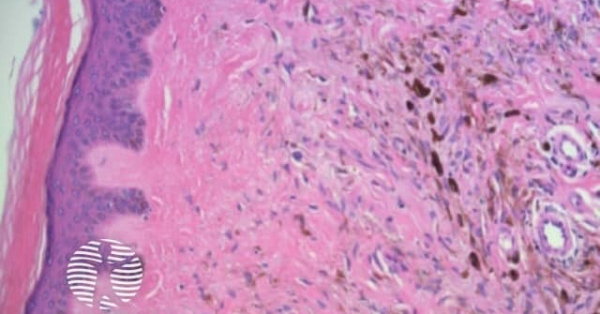 Structureless blue colour of blue naevus on dermatoscopy image