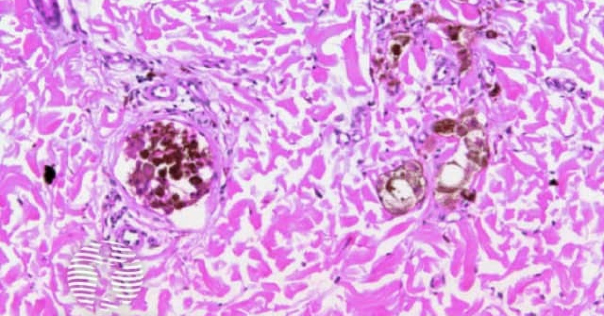 Structureless blue colour of blue naevus on dermatoscopy image