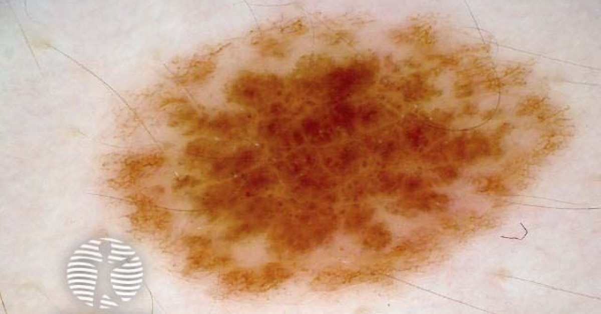 DermNet® - Symmetrical dermoscopic pattern image