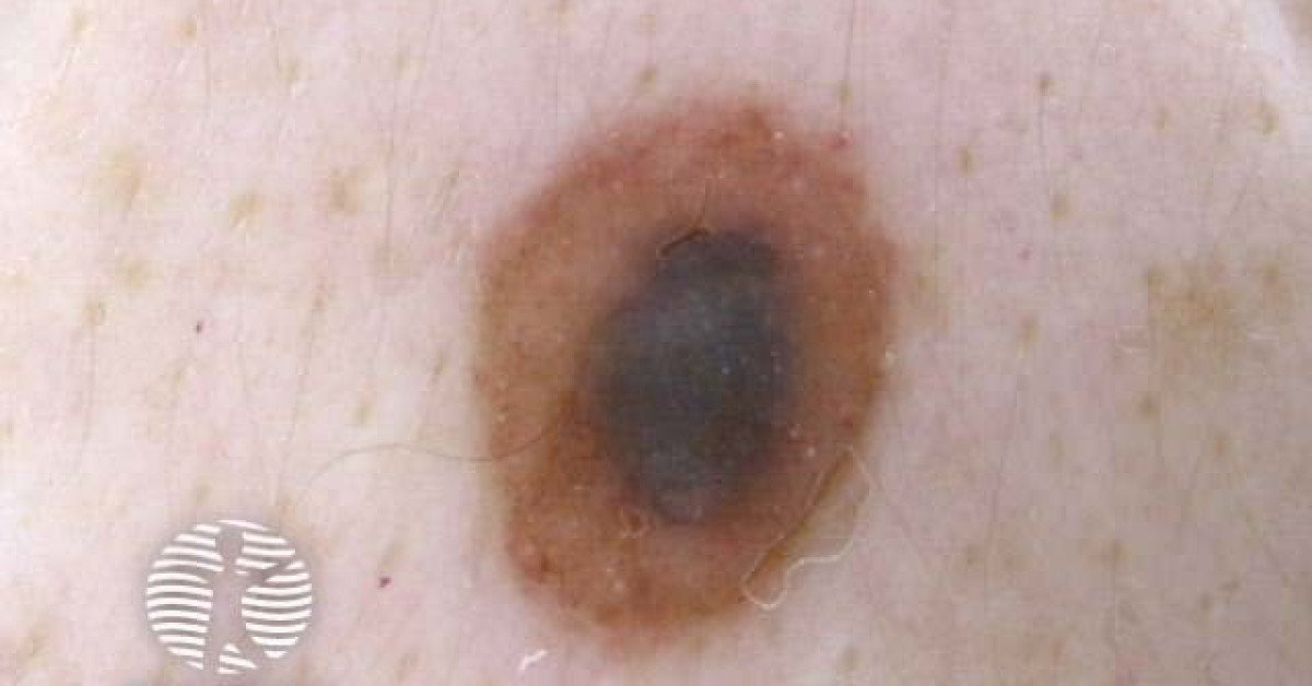 Symmetrical dermoscopic pattern image