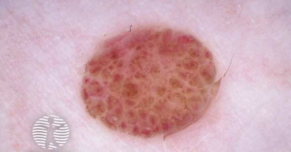 Symmetrical dermoscopic pattern image