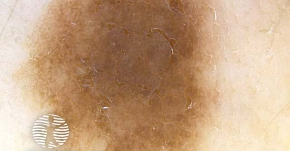 Symmetrical dermoscopic pattern image