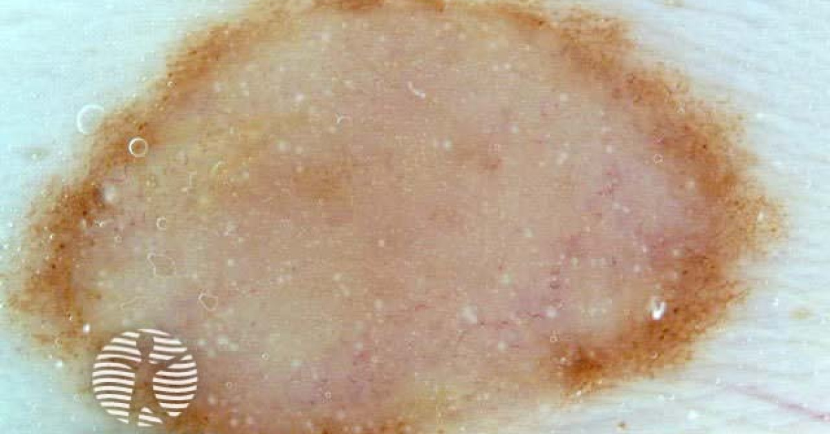 Melanocytic naevus image