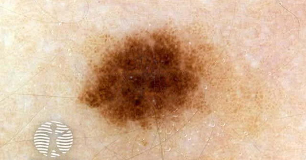 Melanocytic naevus image