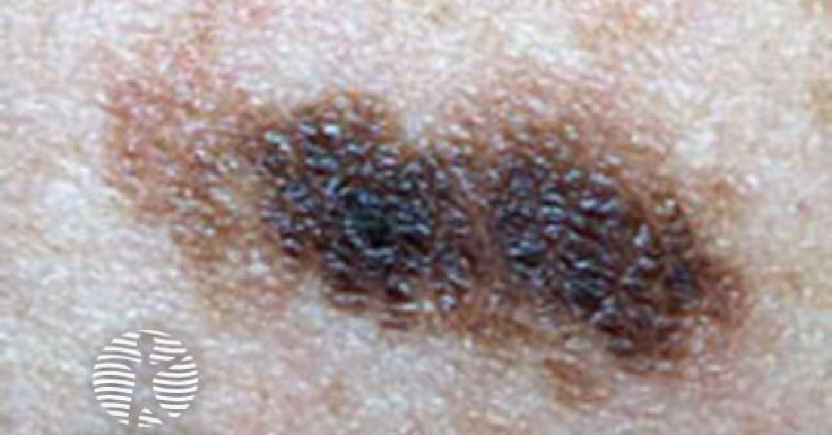 halo naevus clinical image