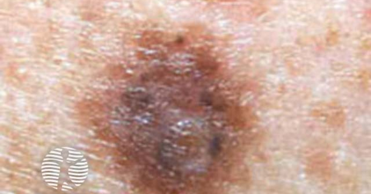 DermNet® - atypical naevus clinical image