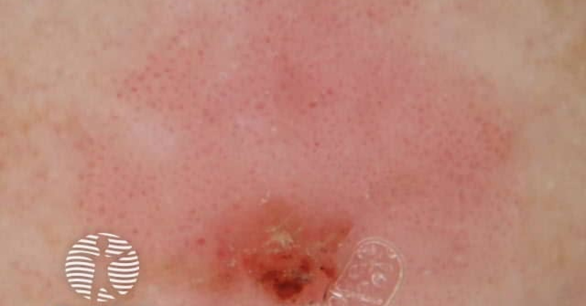 Dermatoscopy of intraepithelial carcinoma image