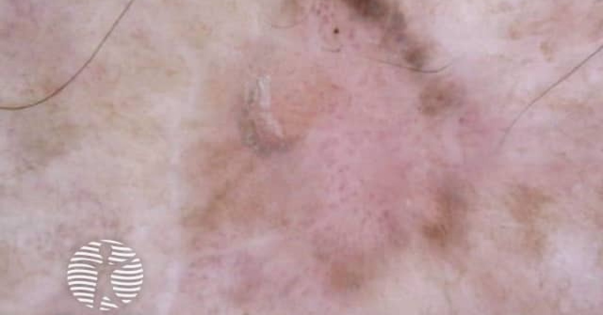 DermNet® - Dermatoscopy of pigmented intraepithelial carcinoma image