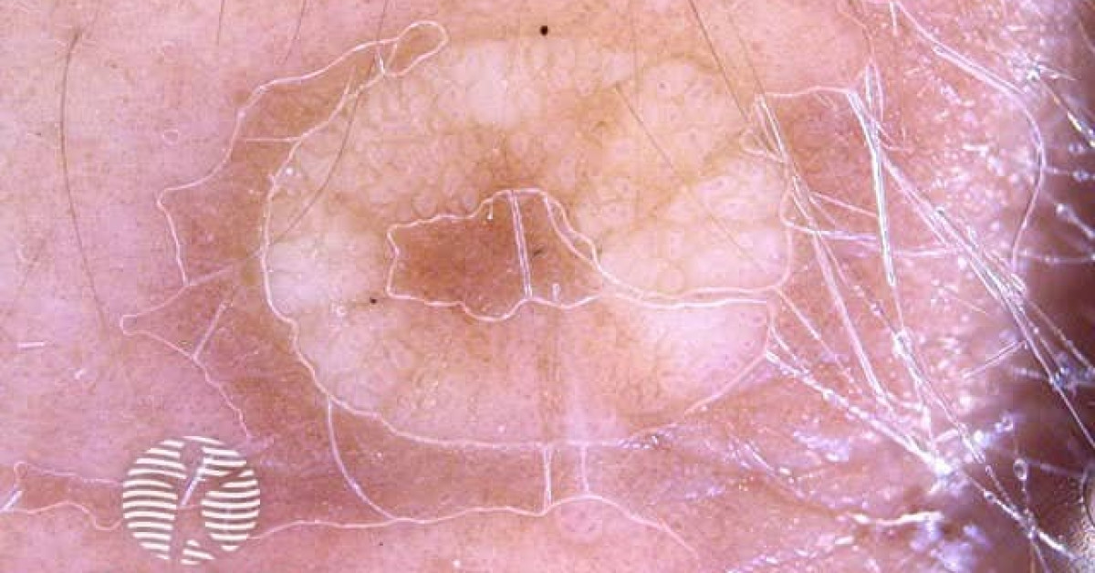 Plane wart image