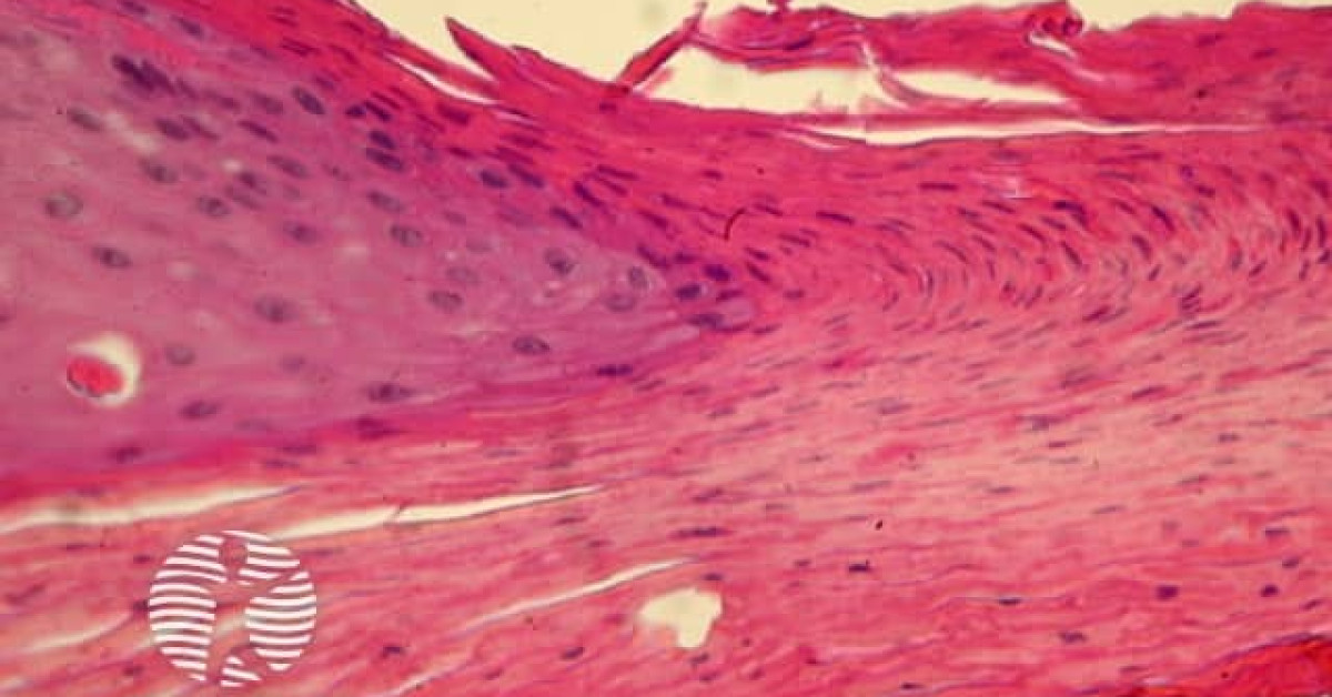 Histopathology of SCC image