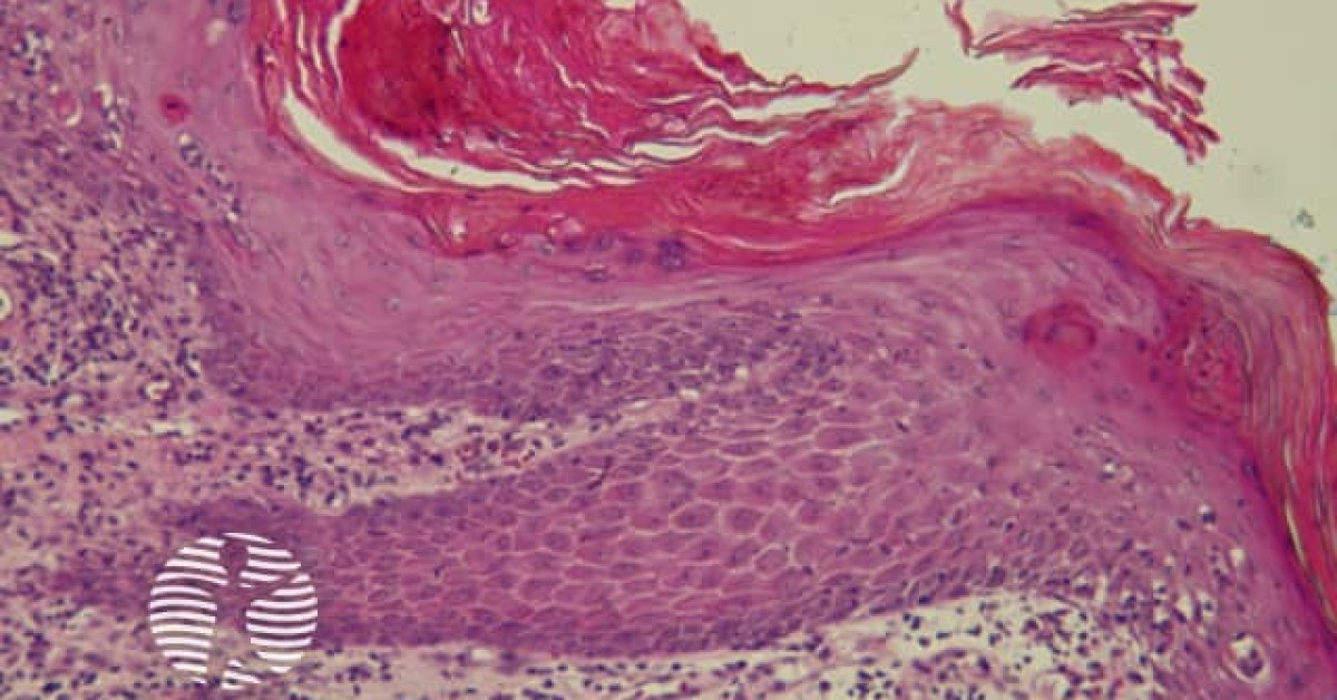 White circles on dermatoscopy of SCC image