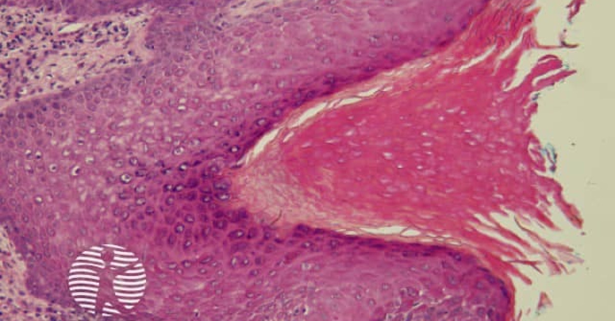 White circles on dermatoscopy of SCC image