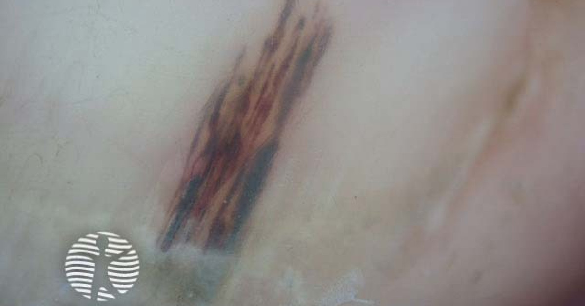 DermNet® - Case 16 image