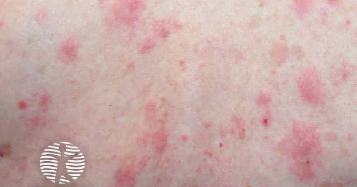 bullous pemphigoid image