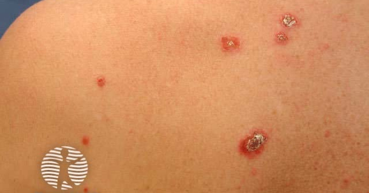 Paraneoplastic pemphigus image