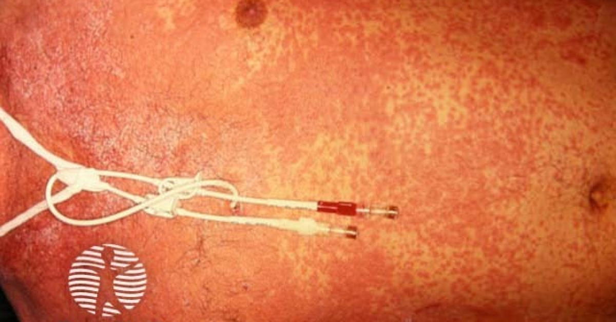 Morbilliform drug eruption image