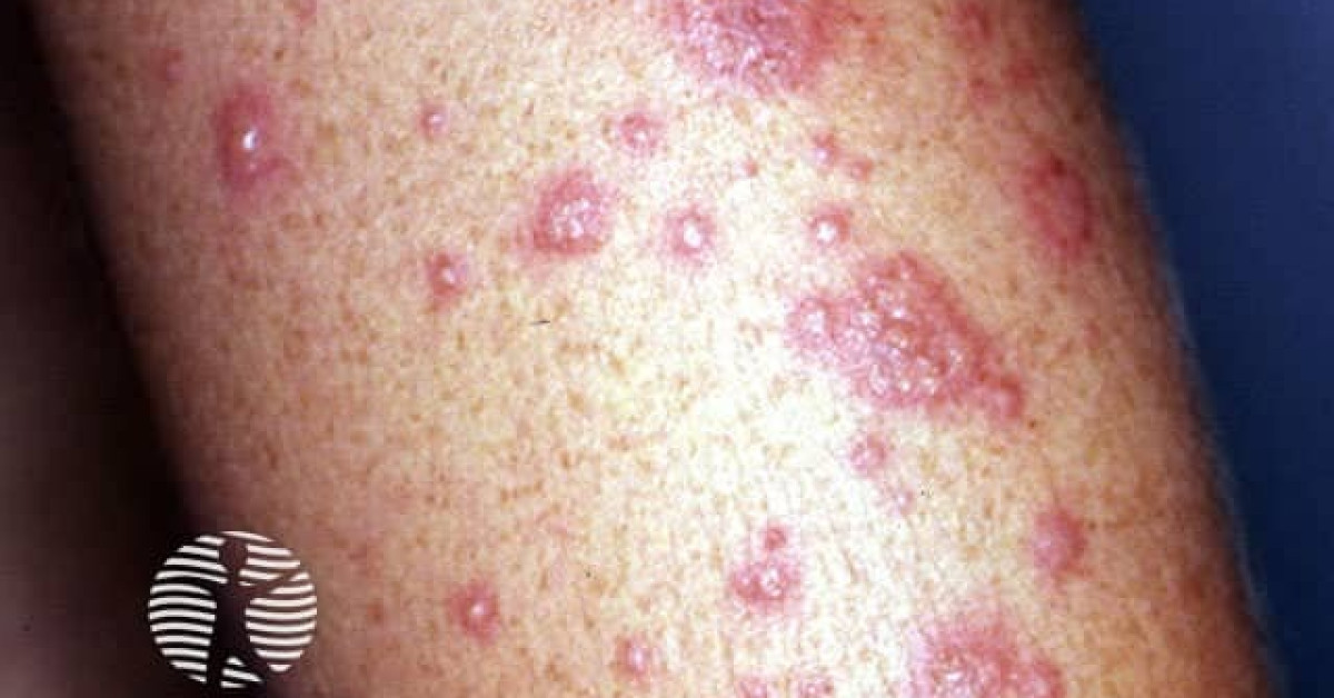 Erythema multiforme minor image