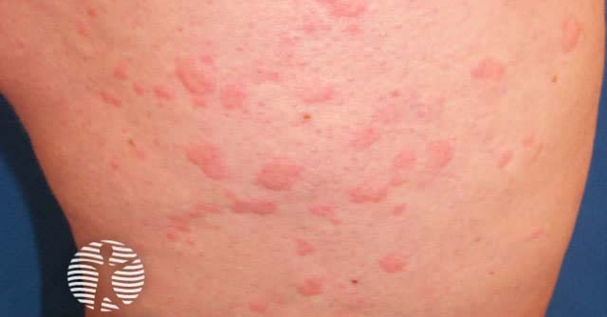 Urticaria image