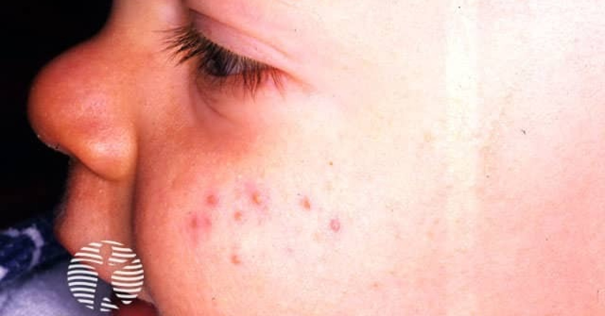 DermNet® - Infantile acne image