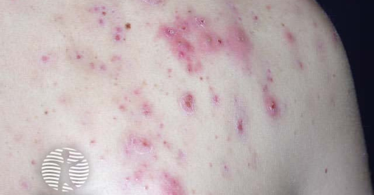 Nodulocystic acne image