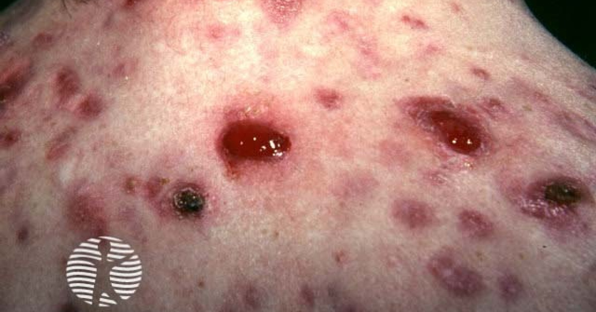 Granulomas and crusted acne lesions image
