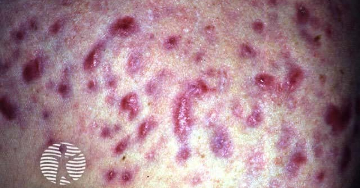 Hypertrophic scarring following acne fulminans image