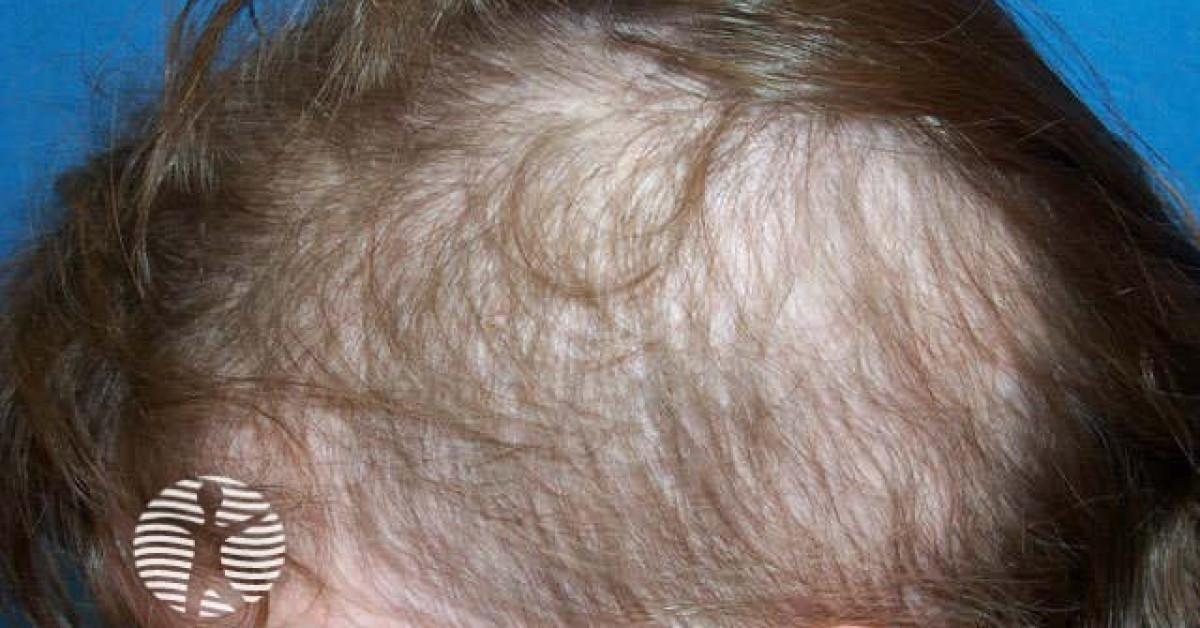 Trichotillomania image
