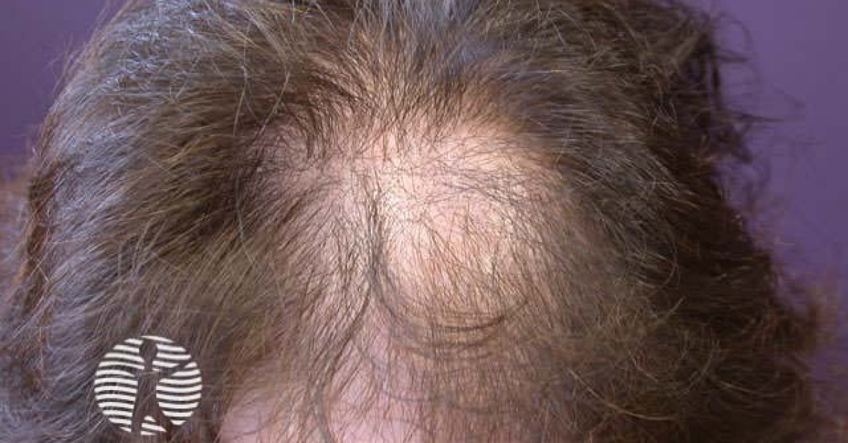 Pattern Balding Female Image