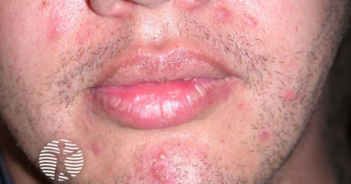 Inflammatory acne image