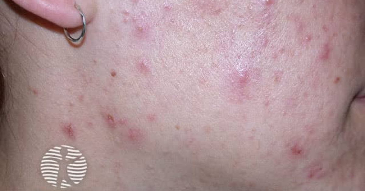 Moderate acne image