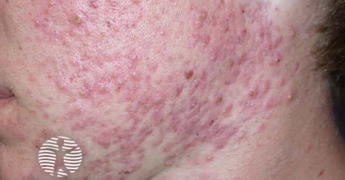 Severe acne image