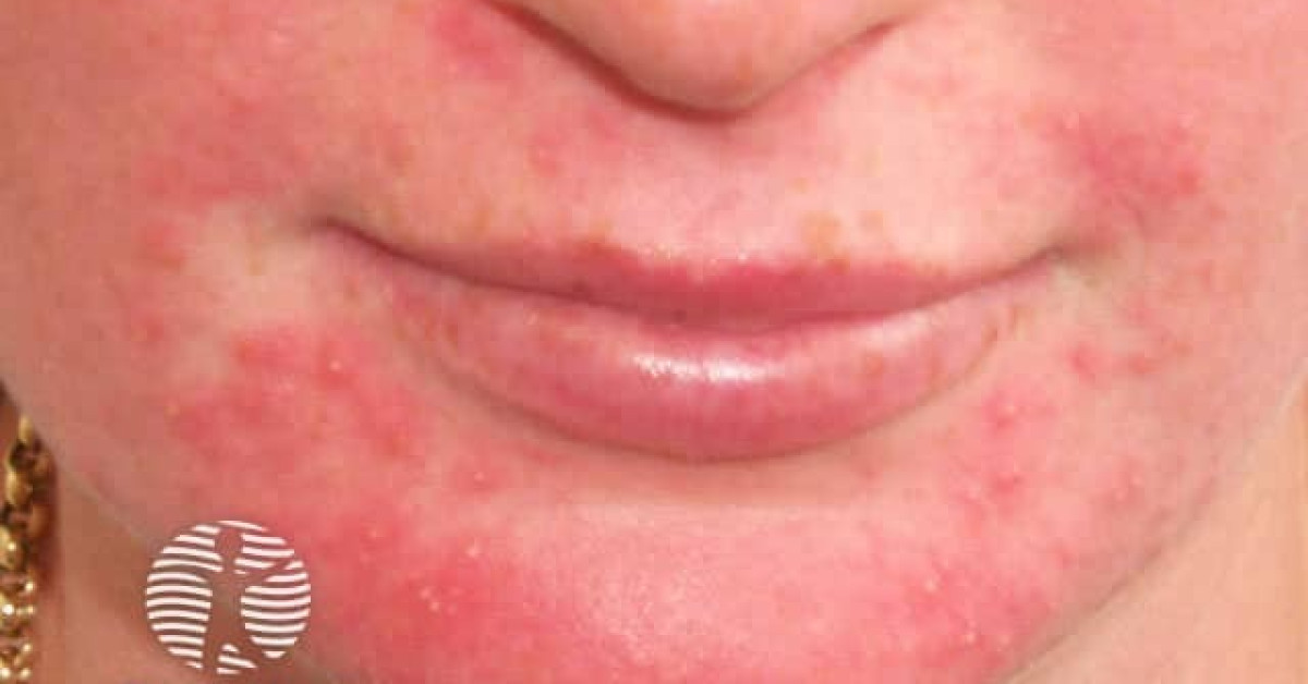 Periorificial dermatitis image