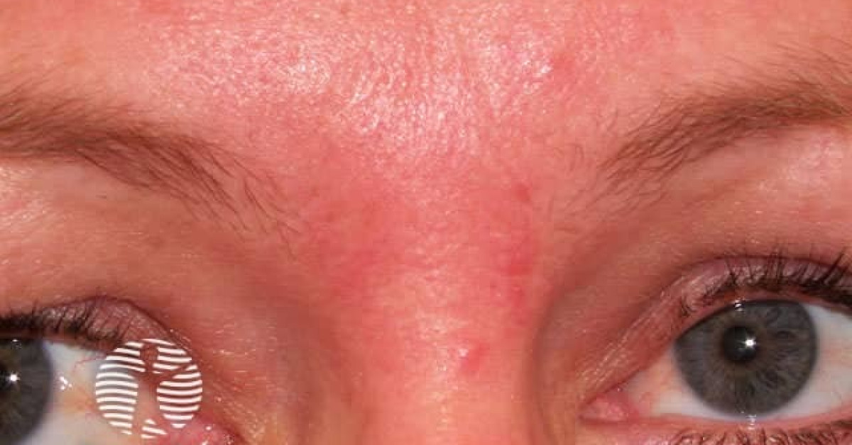 Periorificial dermatitis image