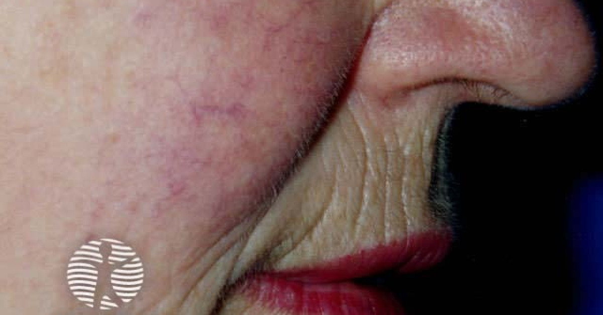Six weeks after single treatment to rosacea with vascular laser image