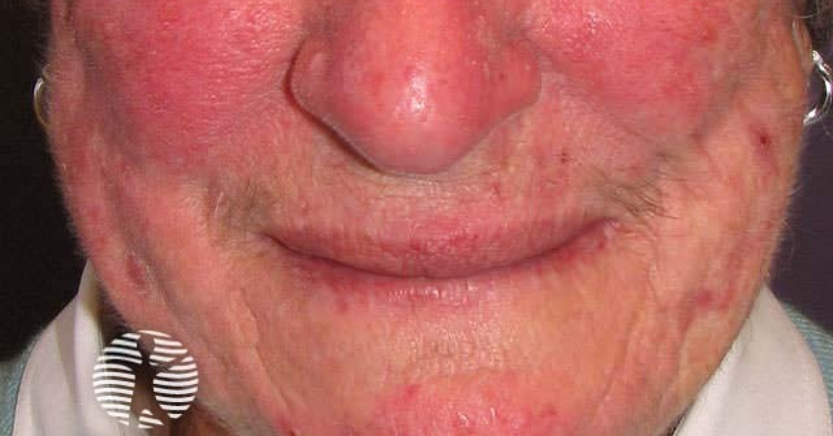 Rosacea image