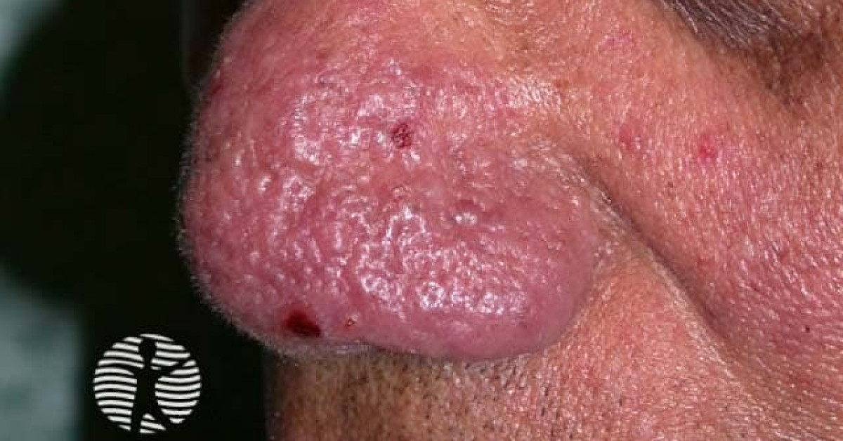 Rhinophyma image