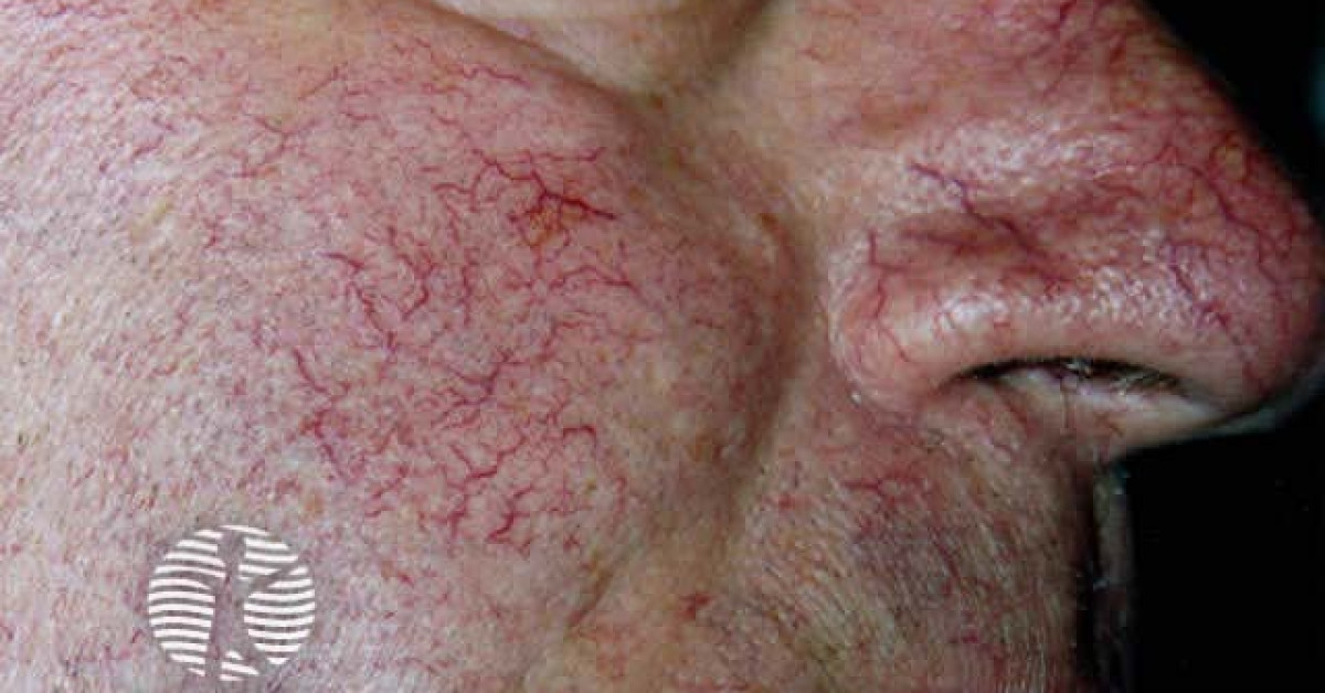 Telangiectasia image