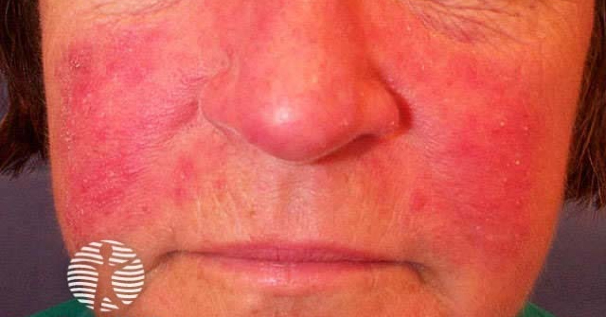 Inflamed rosacea resulting in sensitive skin image