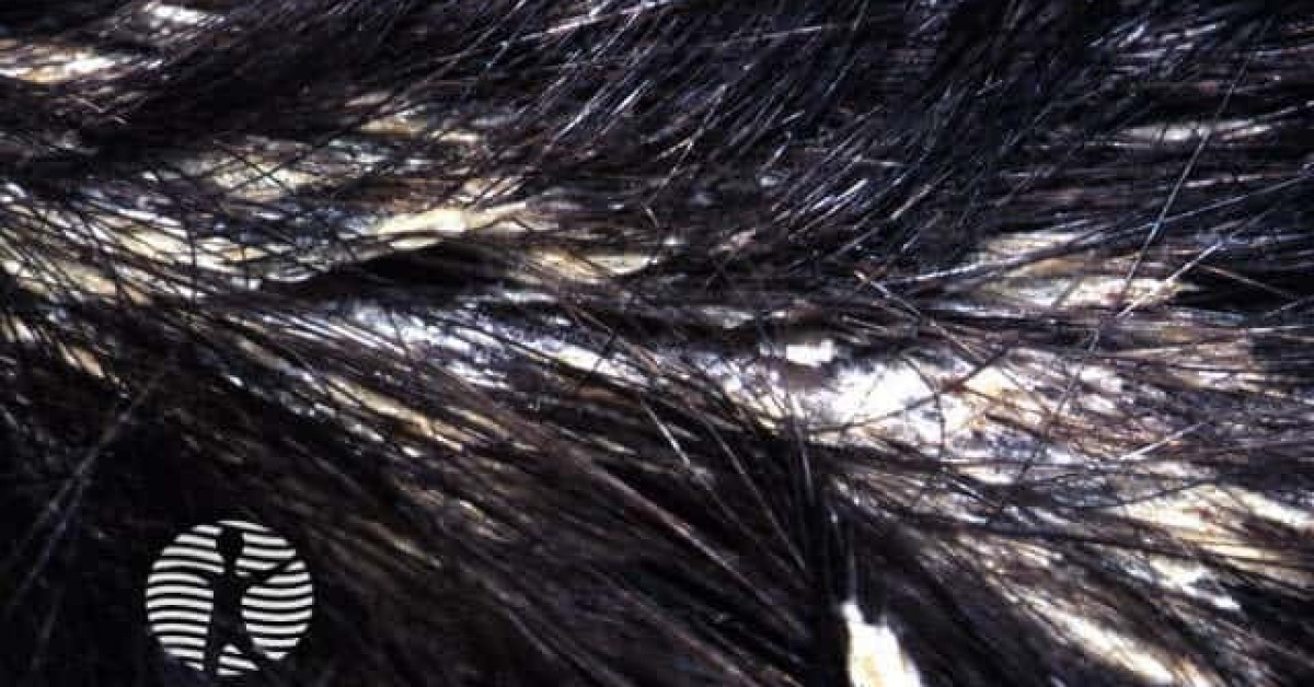 Pityriasis amiantacea image