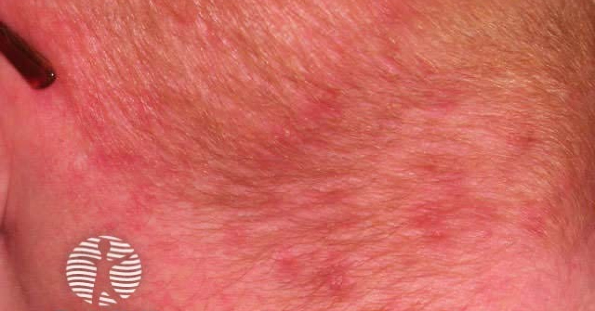 Scalp folliculitis image
