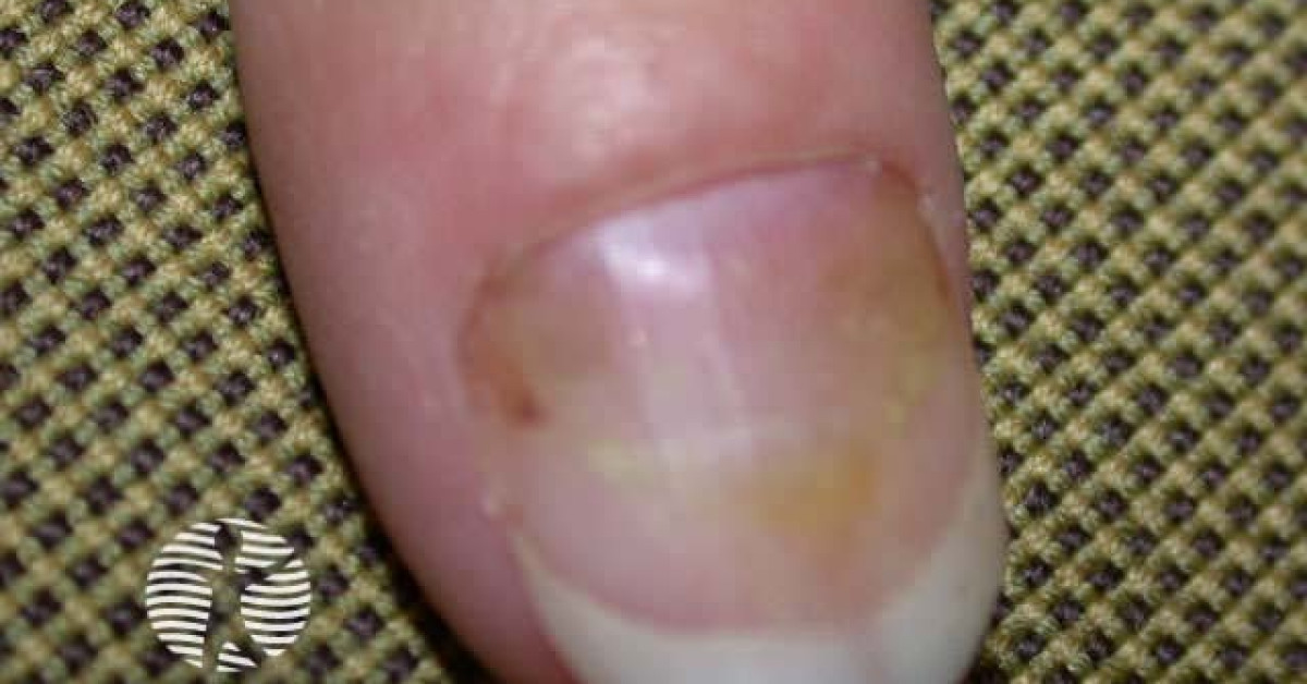 Proximal onchomycosis image