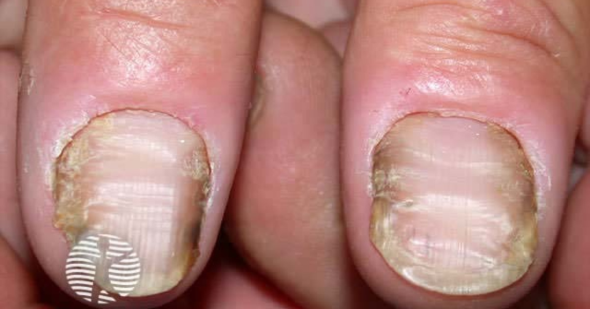 Chronic paronychia image