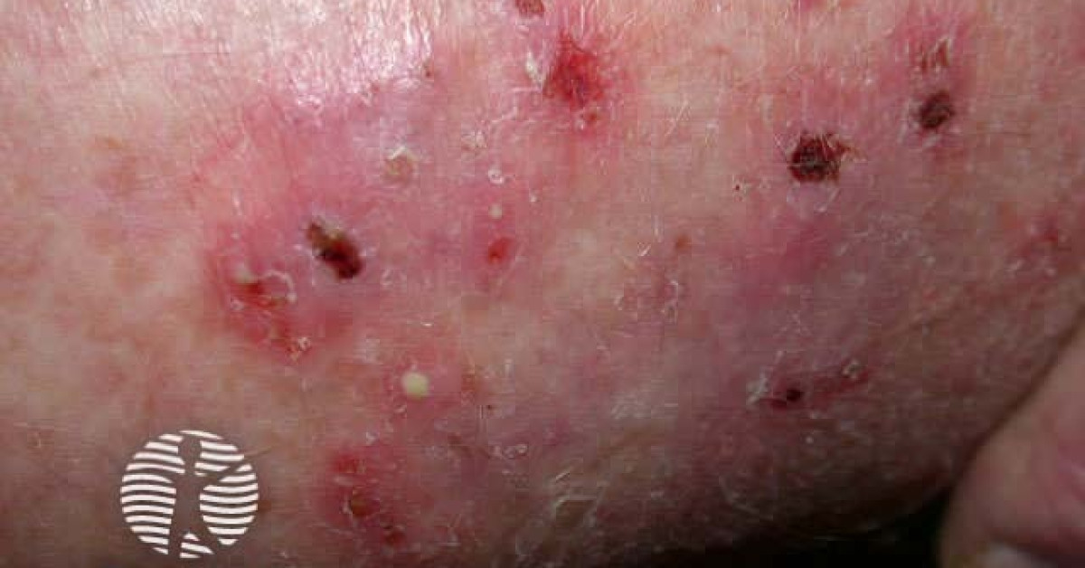 Tinea incognito image