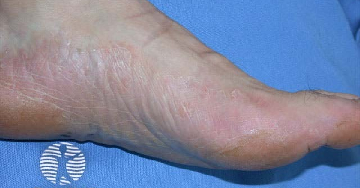Tinea Pedis Image