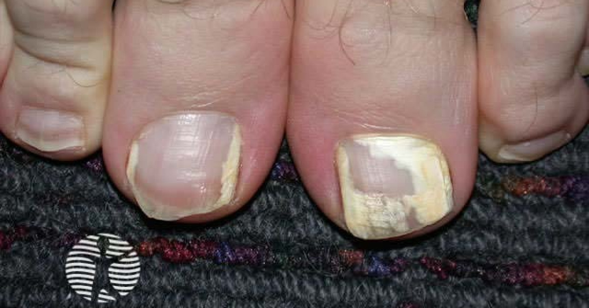 Superficial white onychomycosis image Superficial white onychomycosis image