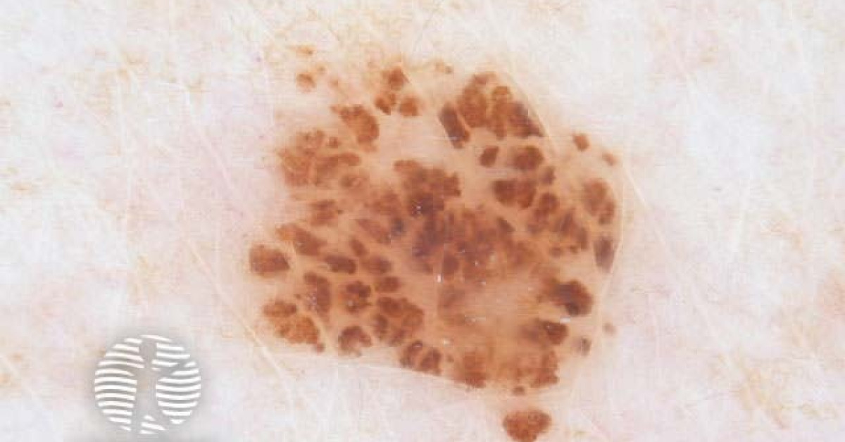 Brown clods on dermatoscopy of dermal naevus image