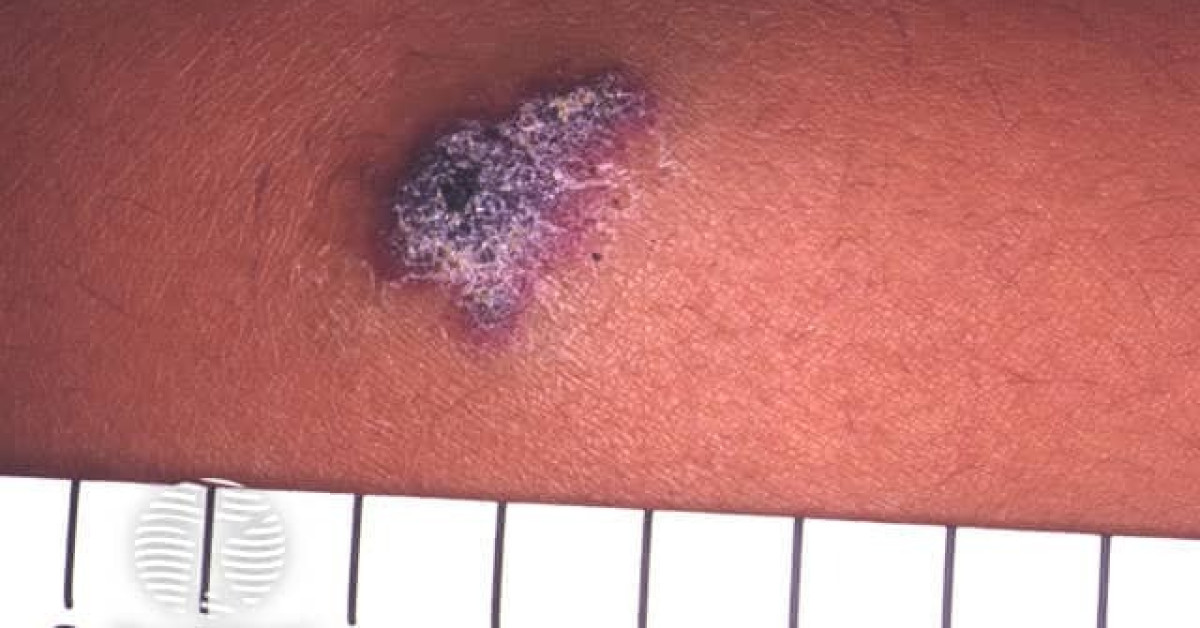 angiokeratoma image